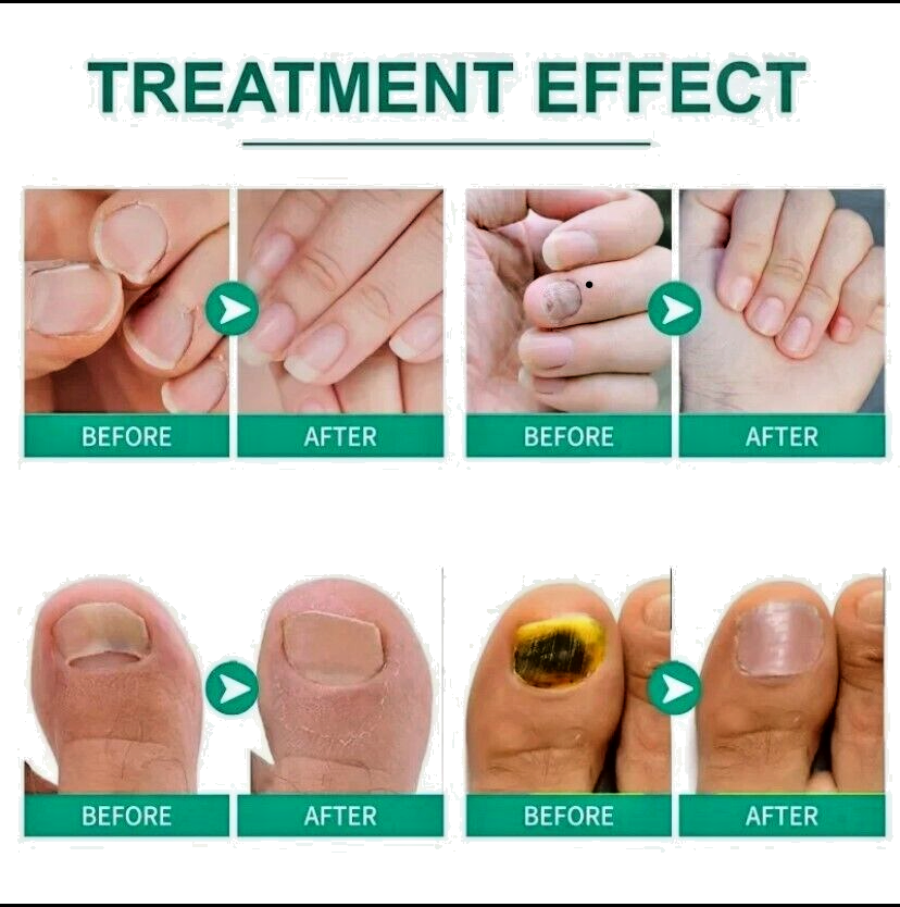 FUNGUS 7 DAYS NAIL FUNGUS TREATMENT ALL NATURAL FORMULA WITH GINGER AND ...