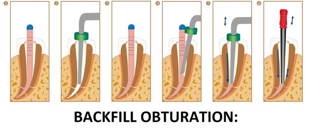 DiaDent Dia-duo Cordless Warm Vertical Compaction & Backfill Endo ...