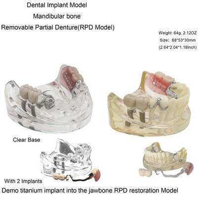 Dental Implant RPD Restoration Model Removable Partial Denture Lower 2 ...