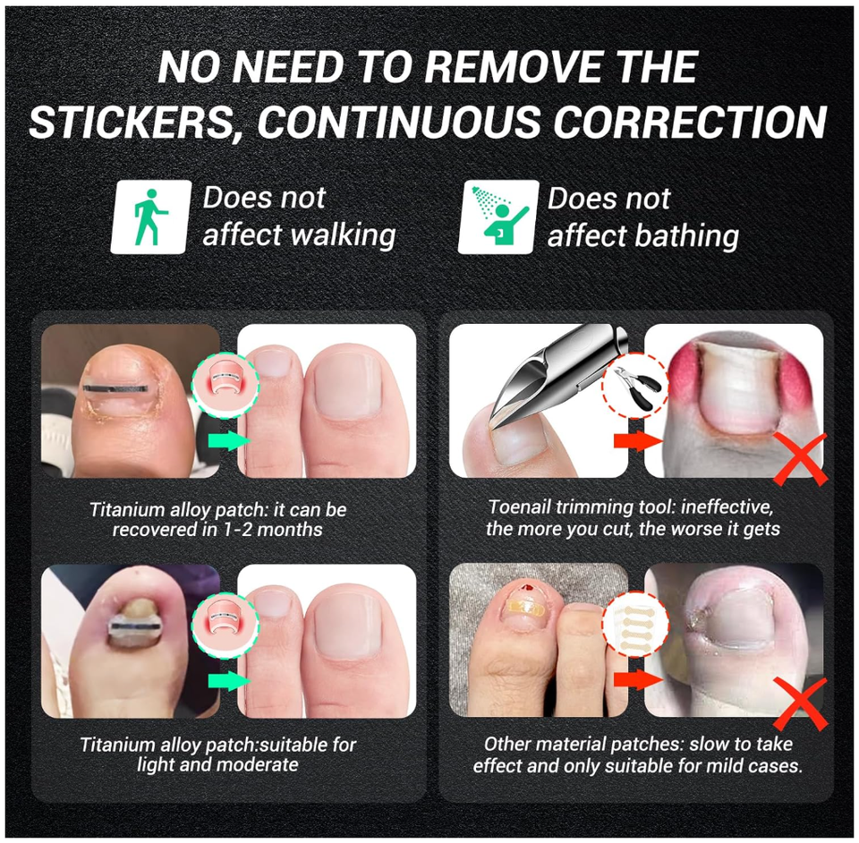 Titanium Alloy Ingrown Toenail Treatment | eBay