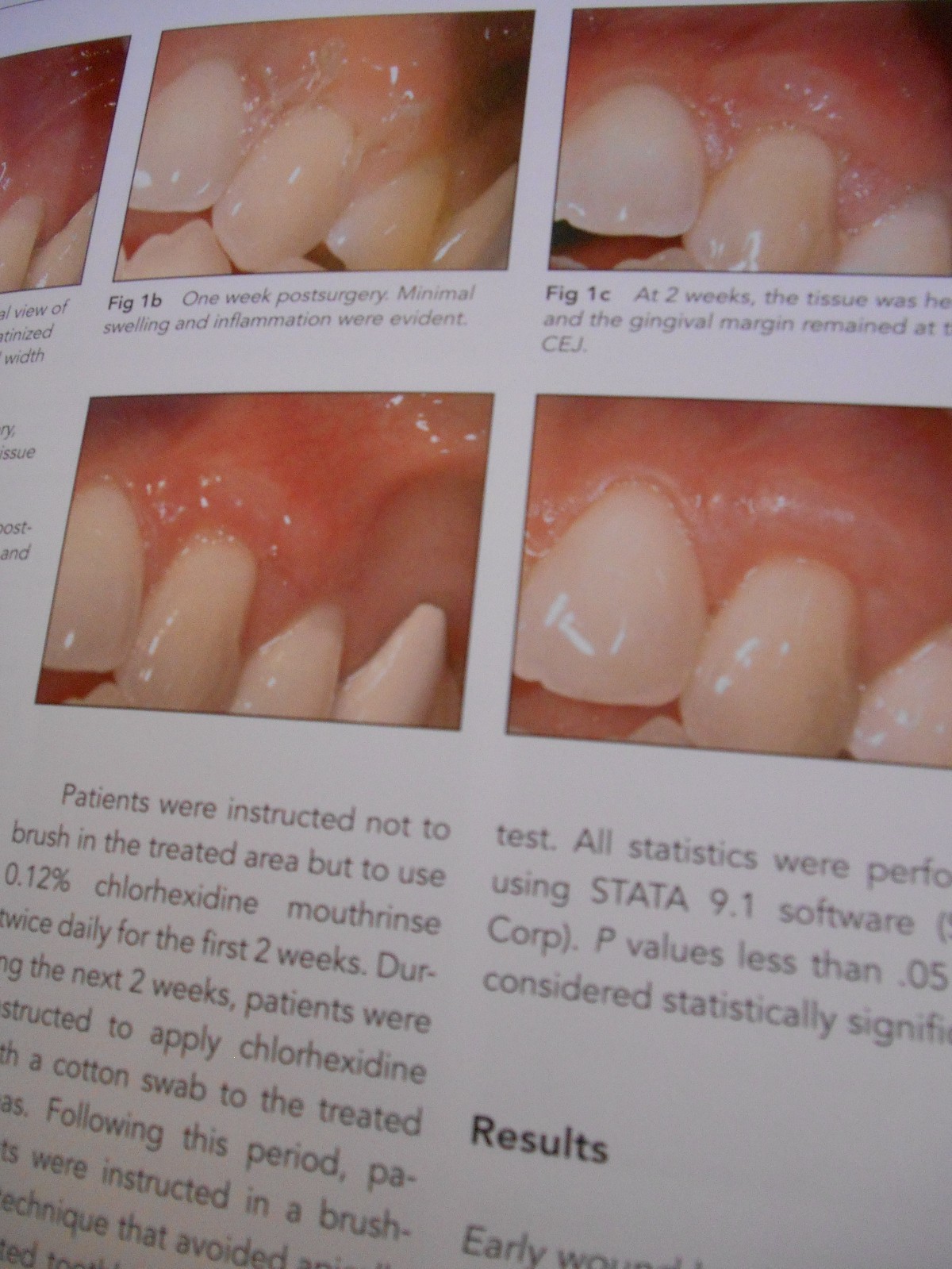 International Journal of Periodontics & Restorative Dentistry vol.33 no ...