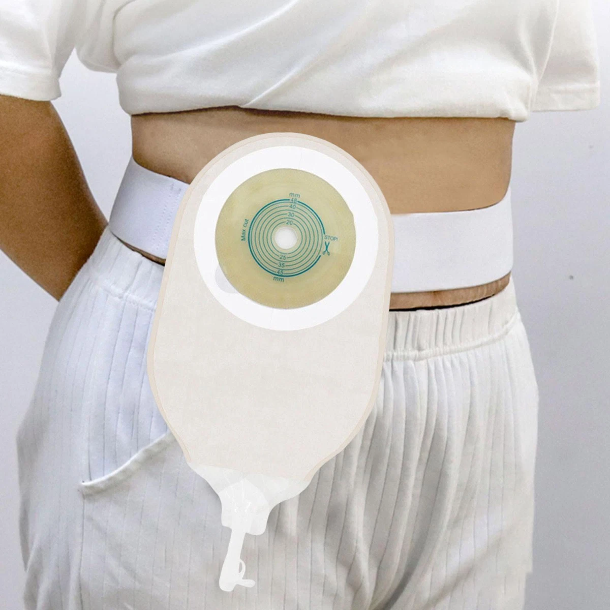 Ileostomy Stoma