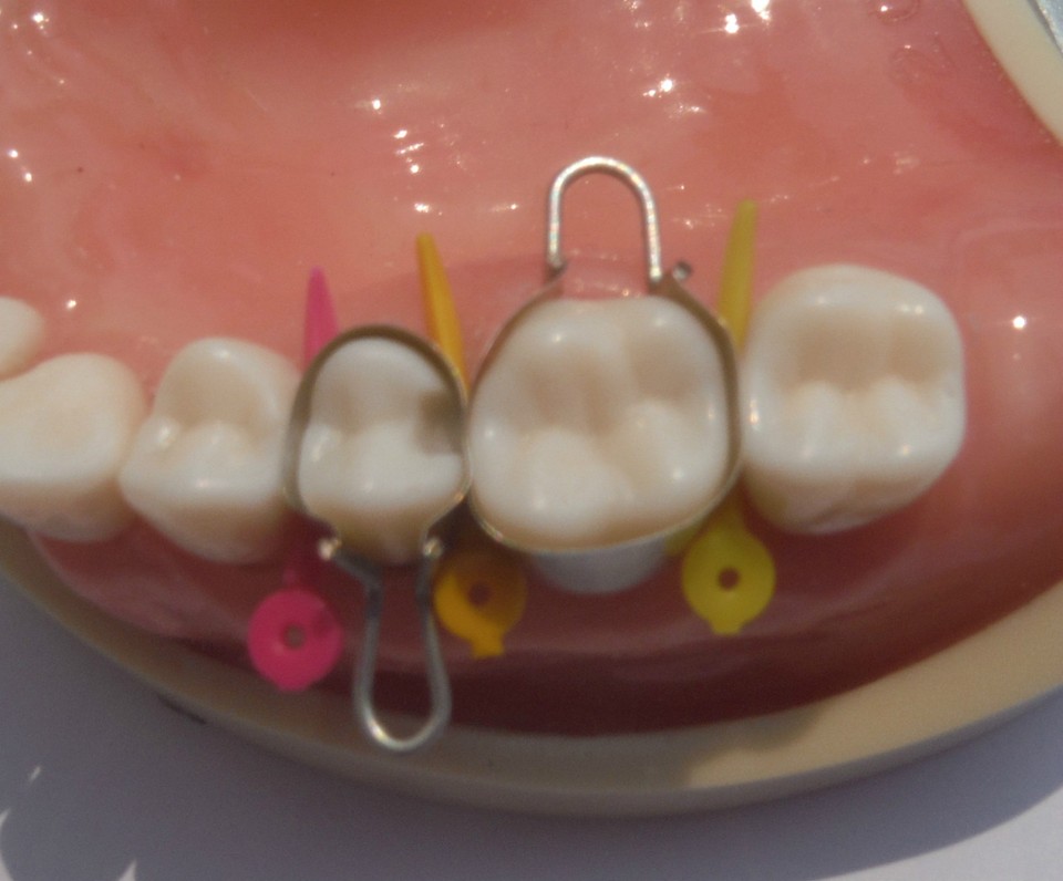 Dental Matrix Bands / The U Dental Bands. MOD Kit. | eBay