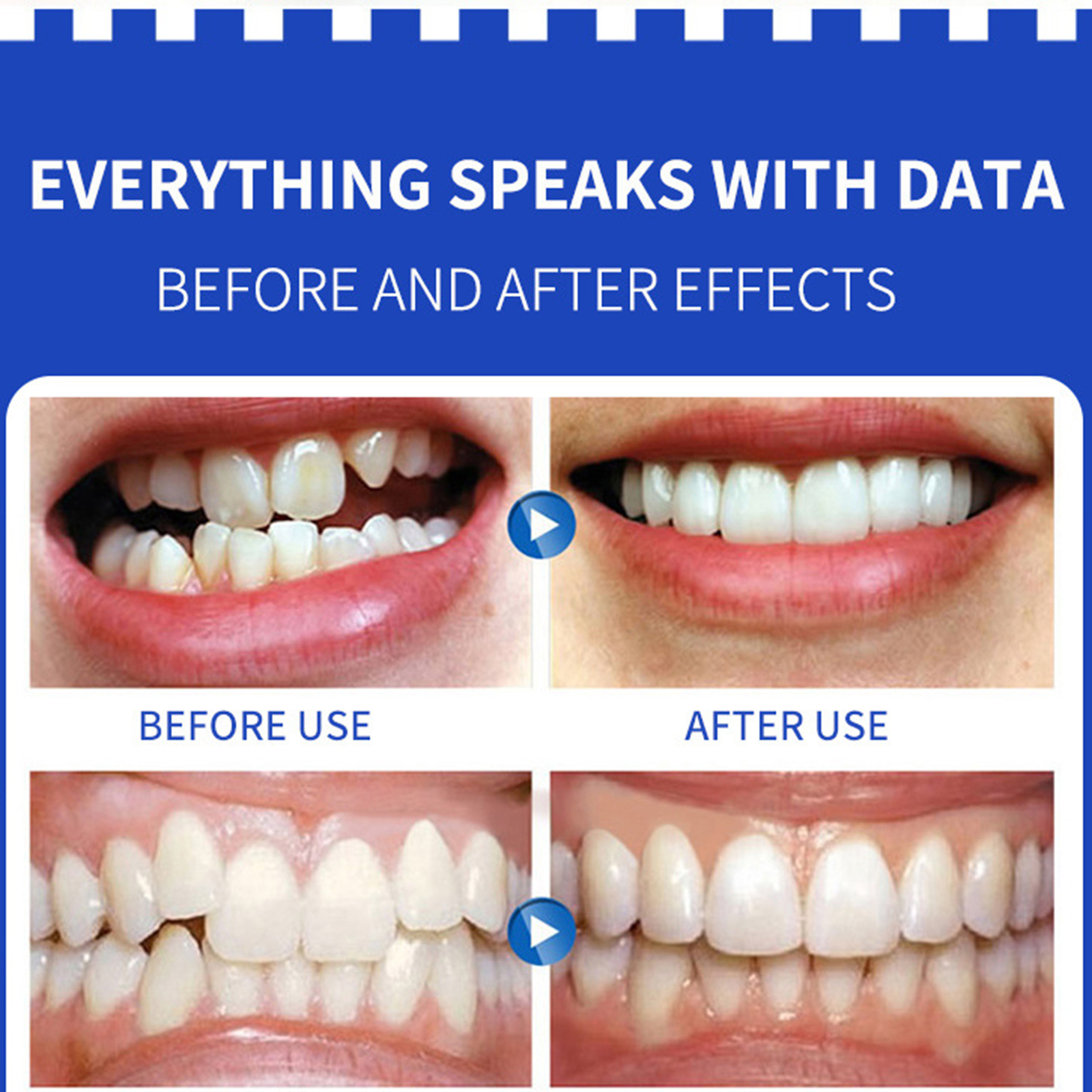 3 Stage Dental Orthodontic Teeth Corrector Braces Tooth Retainer ...