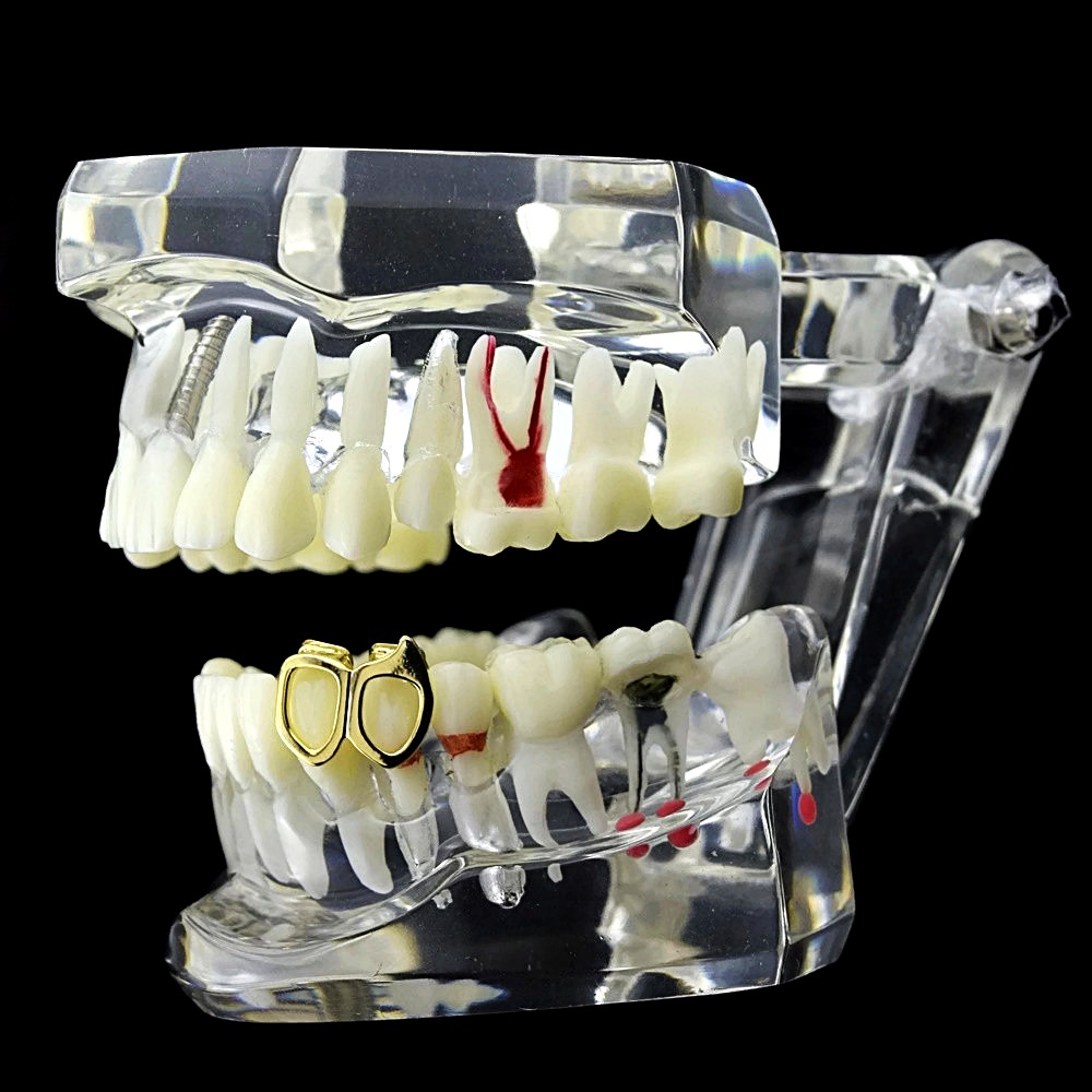 14K Gold Plated Double Open Fang Grillz Bottom Left Canine 2 Tooth ...