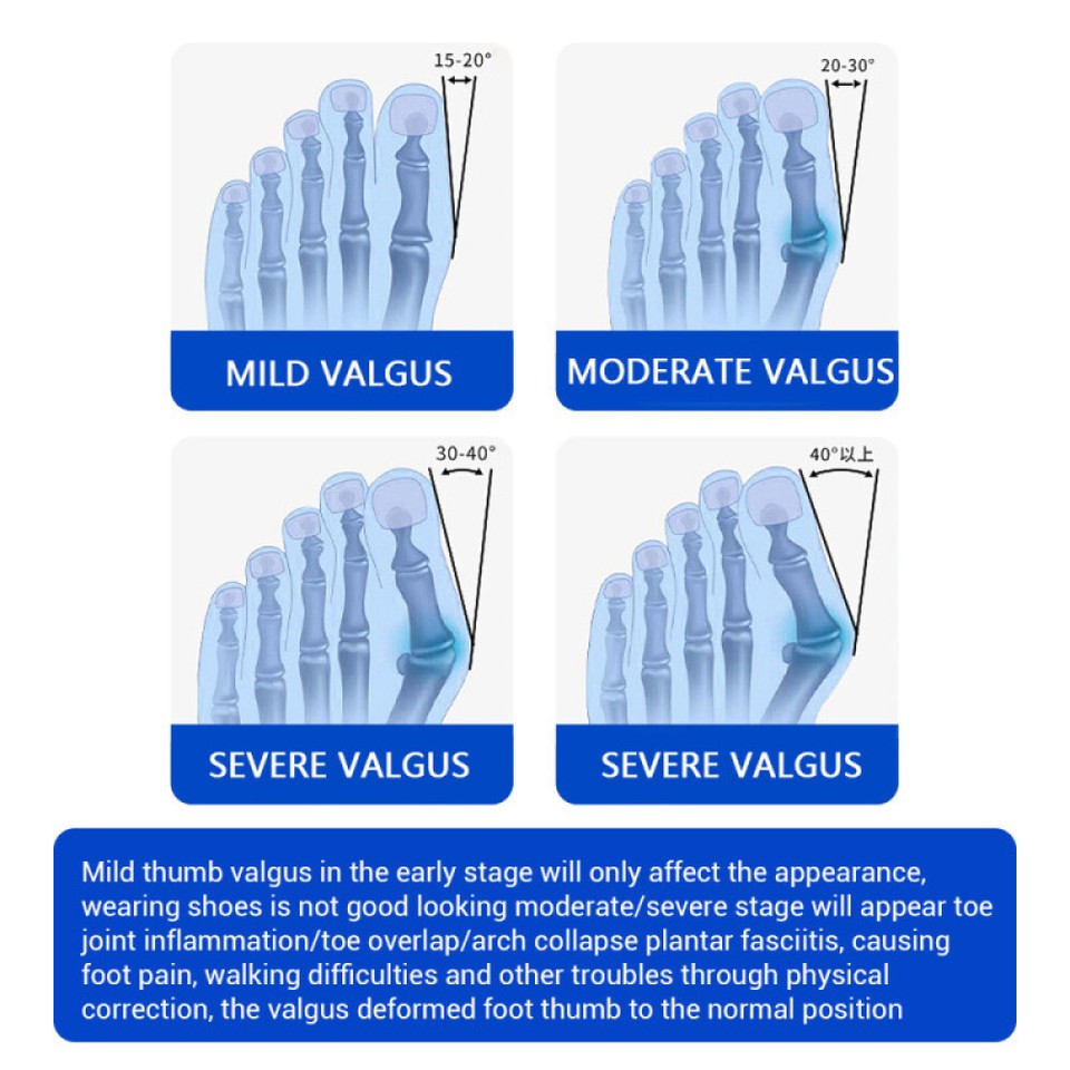 Bunion Fix Toe Valgus Corrector Big Toe Straightener Bunion Correction ...
