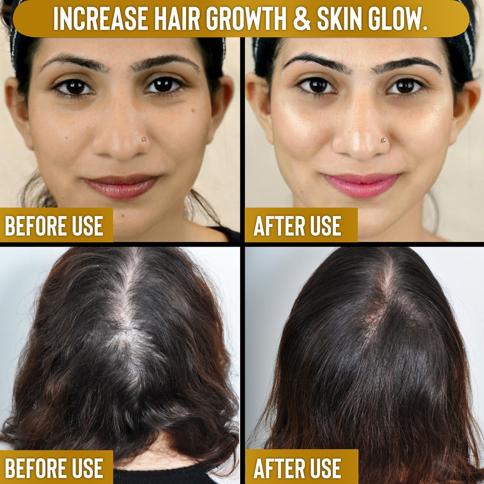 HAIR SKIN FORTE XL Hair Growth Supplement | Hair Skin Vitamins | 10000 ...