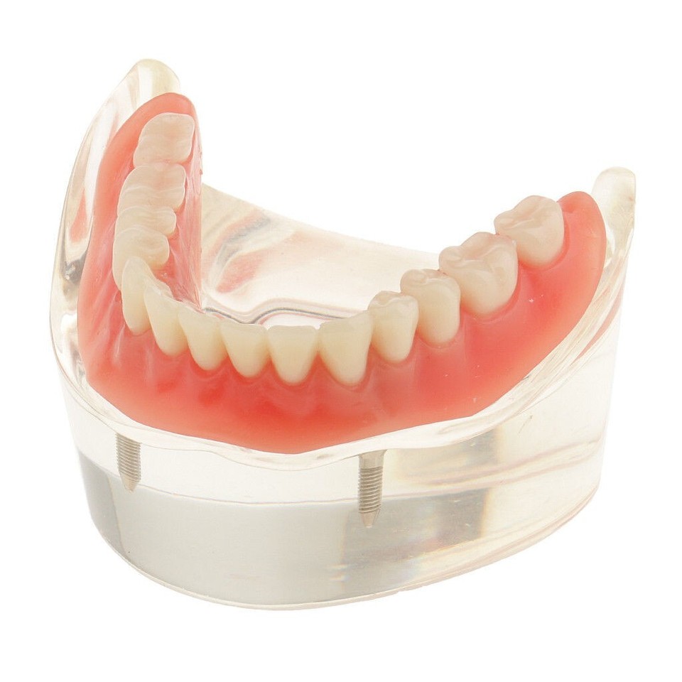 Dental Implant Teeth Model Mandibular Overdenture Restoration 2 Lower ...