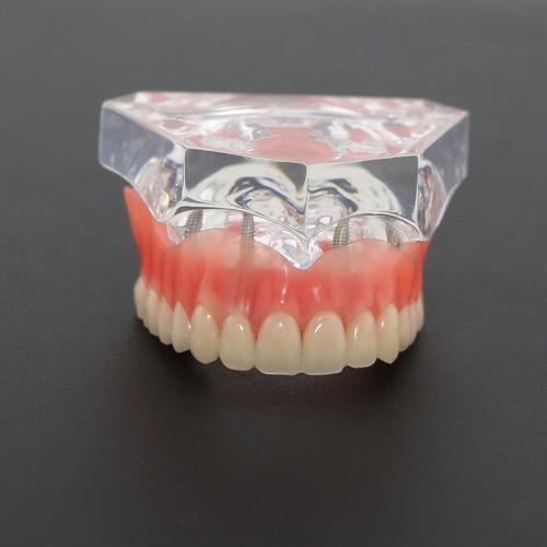 Dental Upper Teeth Model Overdenture Superior 4 Implants Demo ...