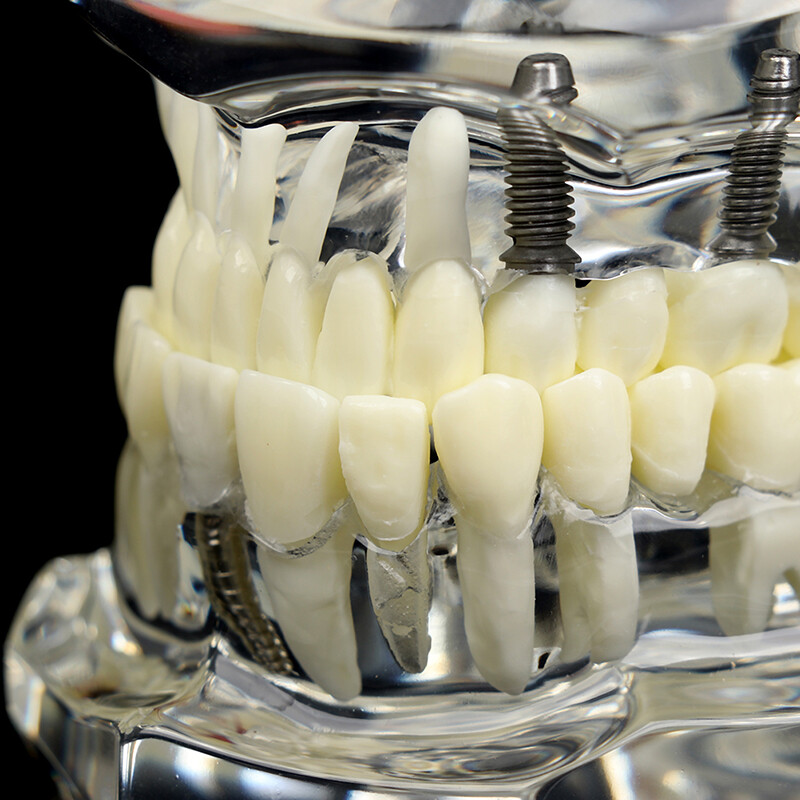 Dental Model Teeth Implant Restoration Bridge Teaching for Study Tooth ...