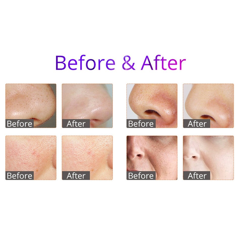 6 in 1 Hydra Machine Water Oxygen Hydro Dermabrasion Facial Deep ...