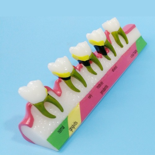 Dental Caries Classify Model Teeth Caries Evolution Decayed Tooth ...