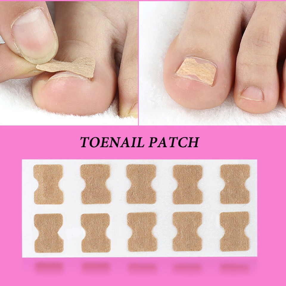 10Pcs Toe Nail Correction Tape Ingrown Toenail Correction Sticker for ...