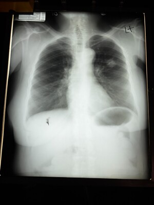 1 XRAY pa ABNORMAL heart chest lung vintage oddity large x-ray 17x14 ...