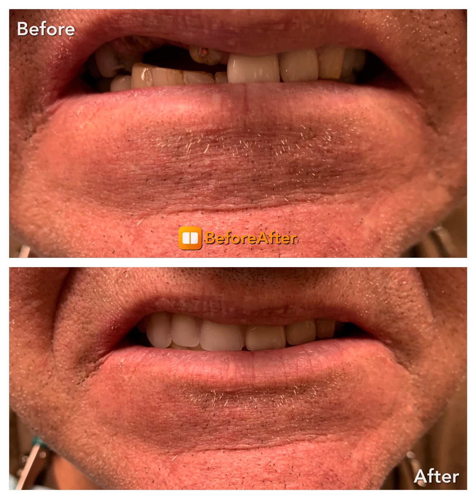 denture,partial,flipper,stayplate,nightguard,sportguard,retainer ...