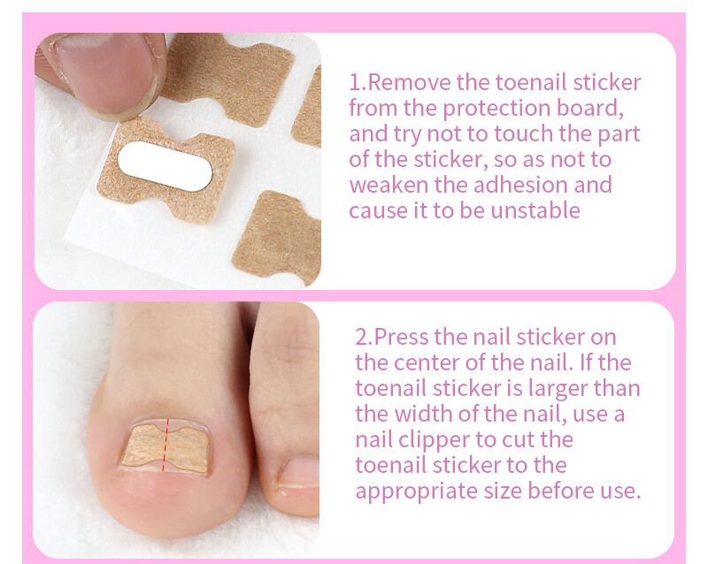 Self Adhesive Ingrown Toenail Corrector Toe Foot Nail Sticker Pedicure ...
