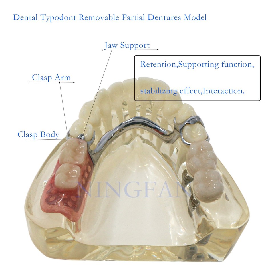 Dental Typodont Removable Partial Denture Model ,PRD Telescopic Crown ...