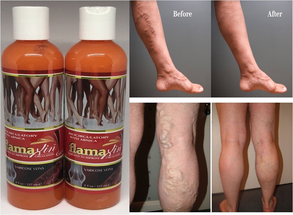 2 VARICOSE SPIDER VEIN SUPPORT GEL FLAMAXIN VARICES VEINS CREAM | eBay