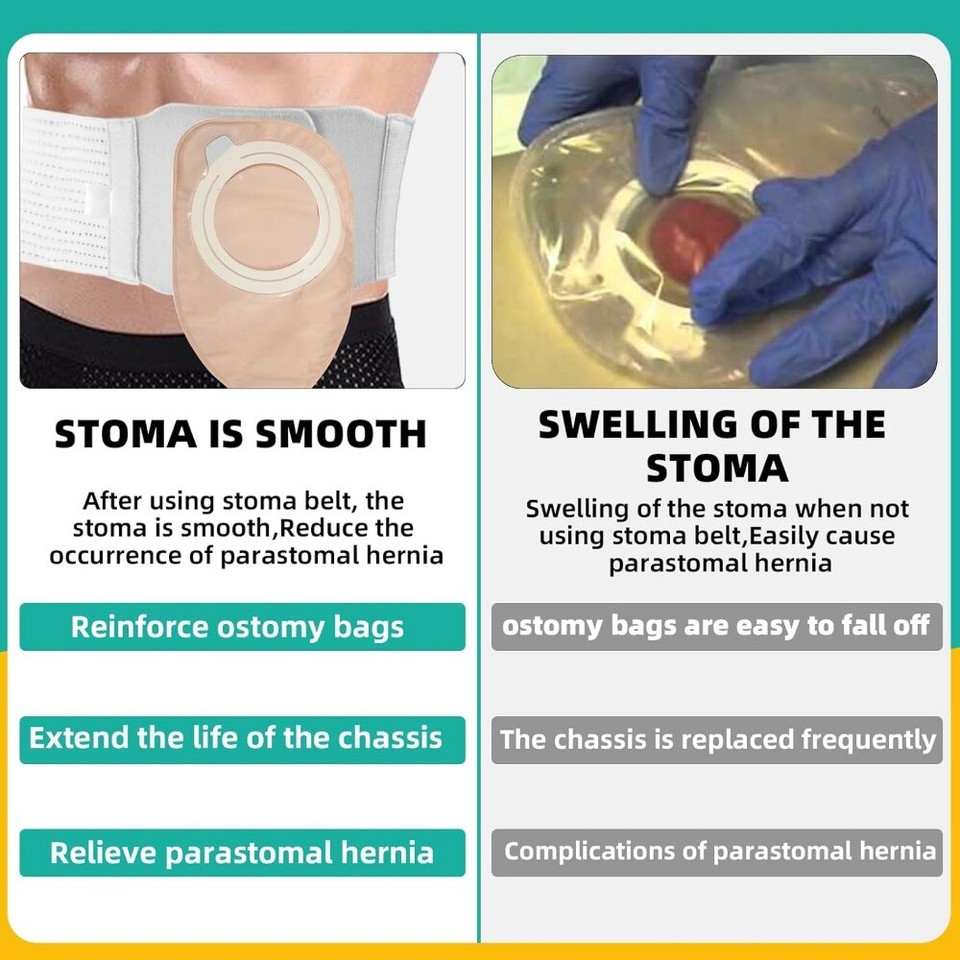 1x Ostomy Support Belt Adjustable Stoma Belt Ileostomy Colostomy Belt ...