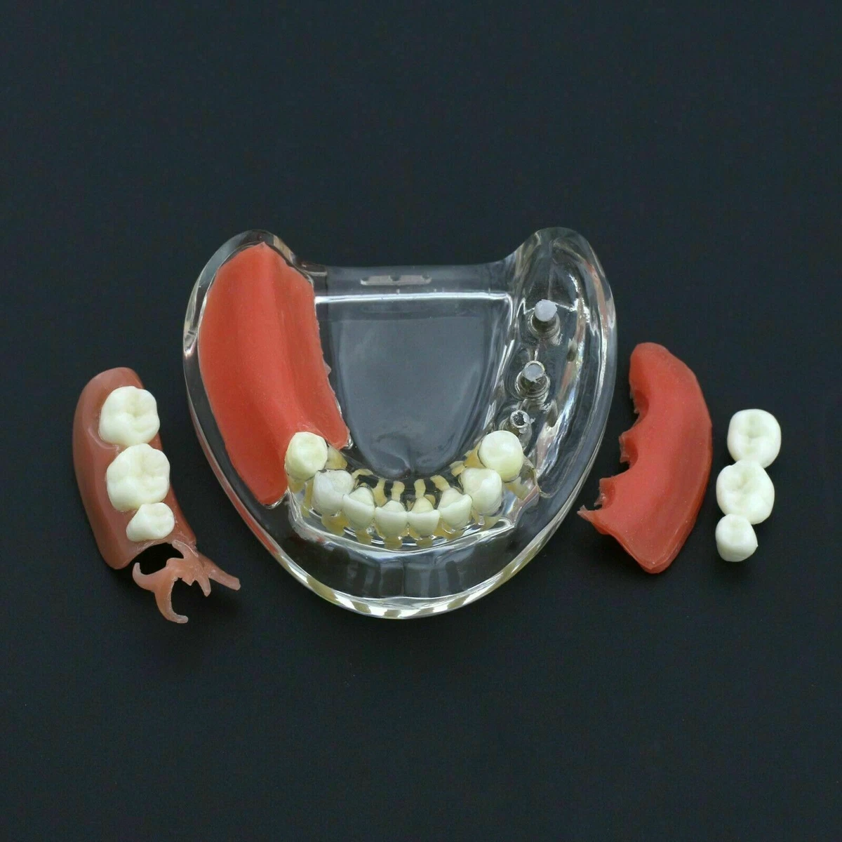 Unilateral Removable Partial Denture