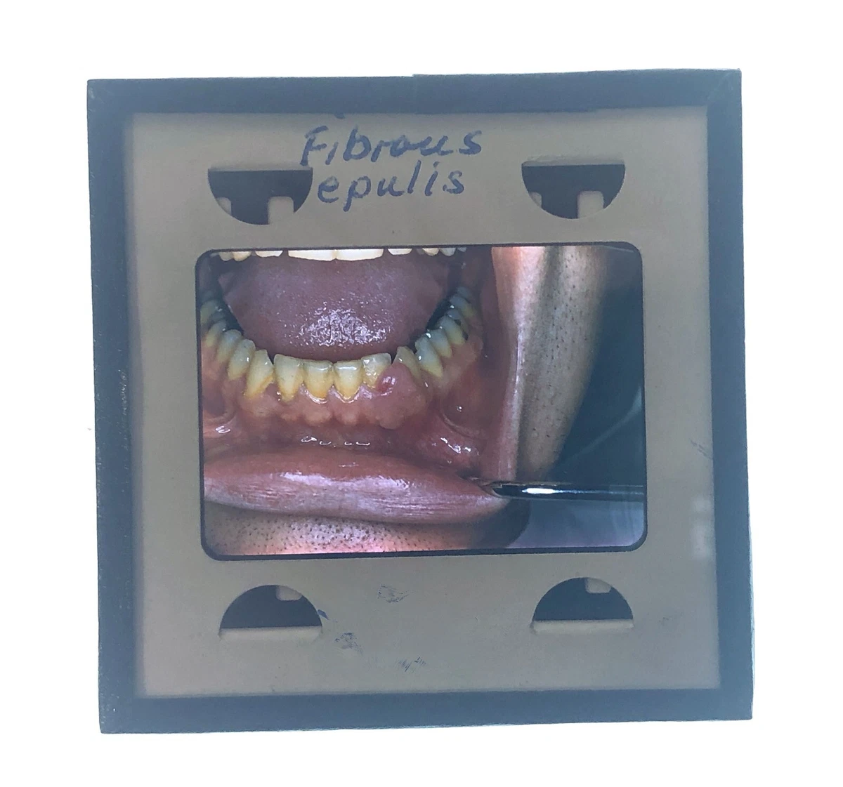 Fibrous Epulis