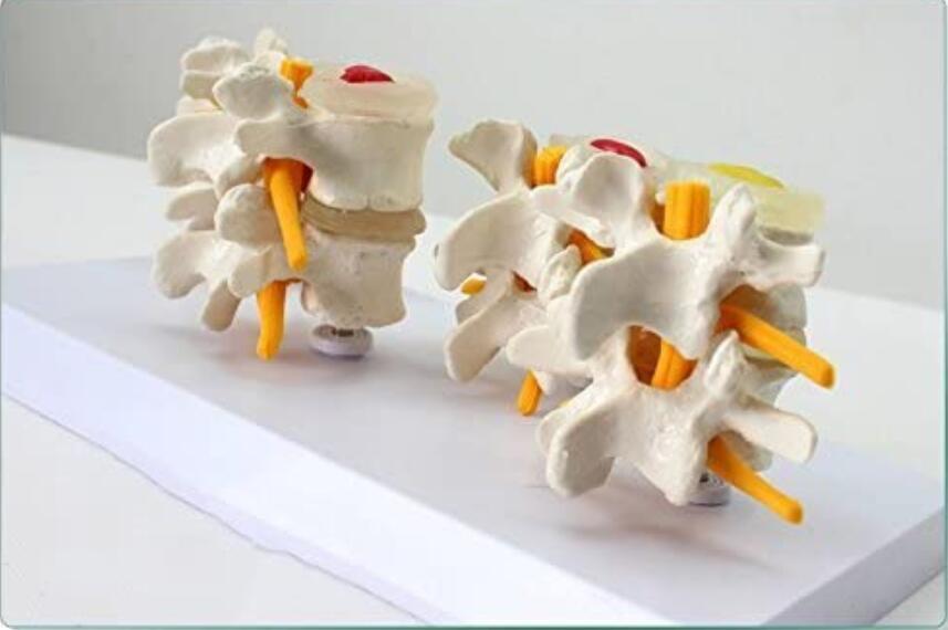 PVC Anatomical Human Lumbar Vertebrae Degenerative Disc Disease Model 2 ...