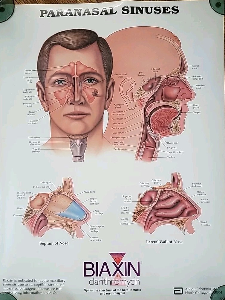 Paranasal Sinuses Sinusitis Information | Mount Sinai New York