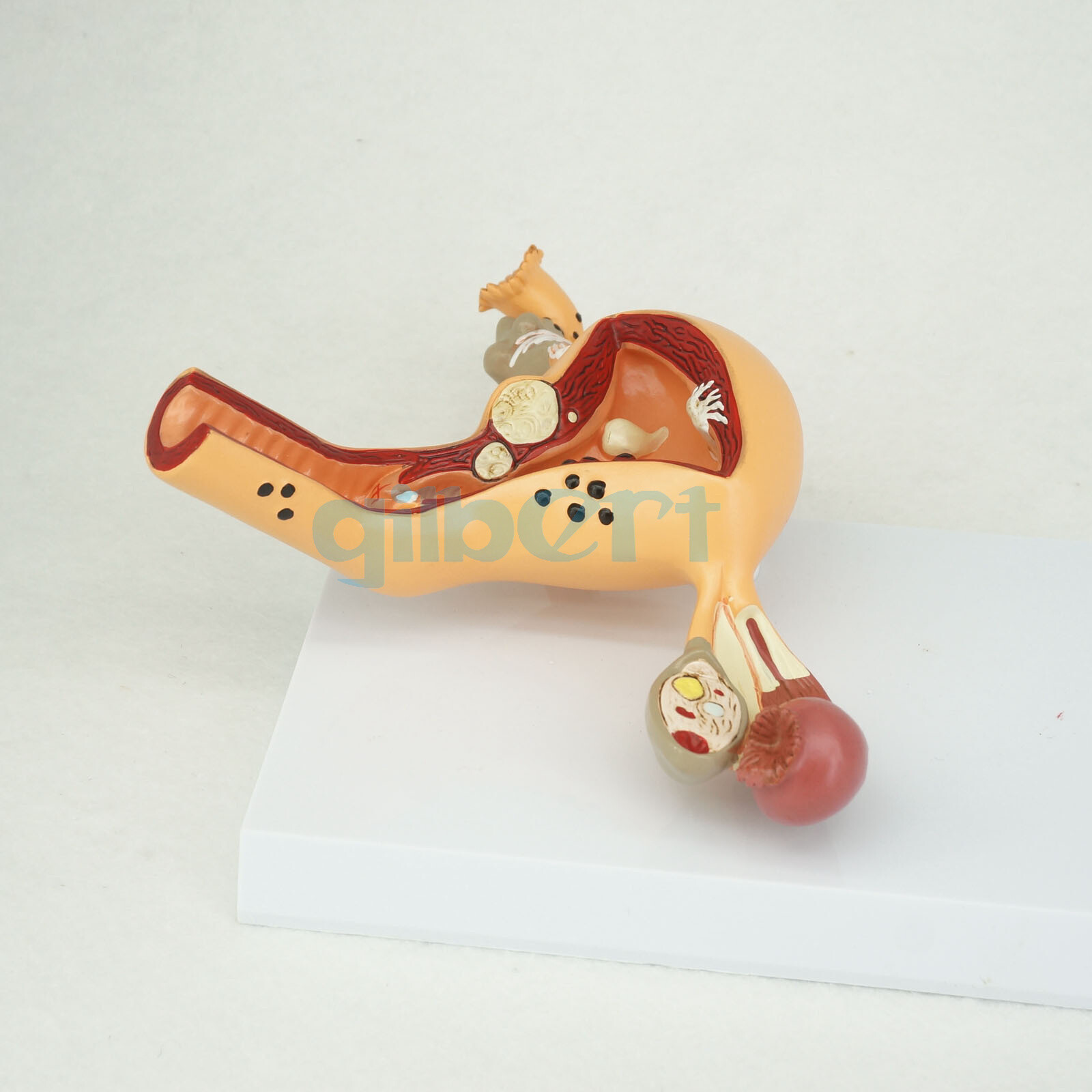 Pathological Uterus and Ovary Anatomical Model Human Female Medical ...