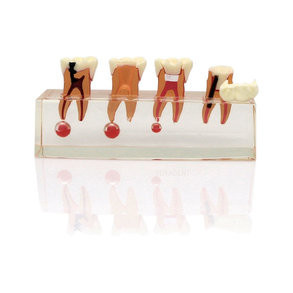 Dental Teeth Model Periodontal Disease Assort Model Endodontic Teaching ...