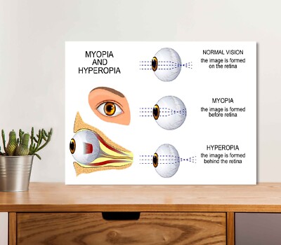 Human Myopia & Hyperopia Eye 5mm thick Plastic Poster Ready to Hang ...