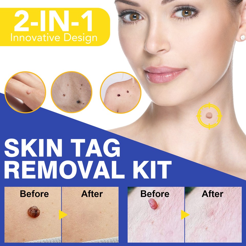 Auto Skin Tag Removal Tool Kit Painless Skin Label Mole Acne Wart ...