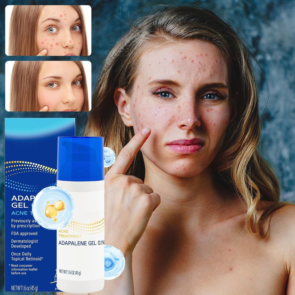 Gel Acne Treatment 45G 90 Day Supply Rx Strength Adapalene Retinoid ...