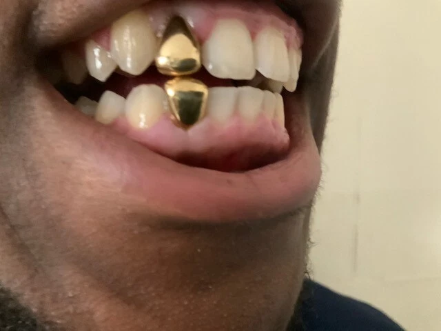 Silver Canine Tooth Cap