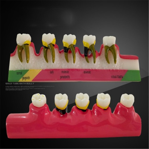 Dental Caries Classify Model Teeth Caries Evolution Decayed Tooth ...
