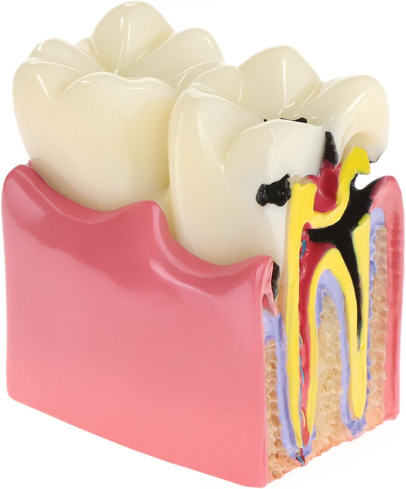 6X Enlarged Dental Caries Tooth Model Resin Cross Section Anatomy ...