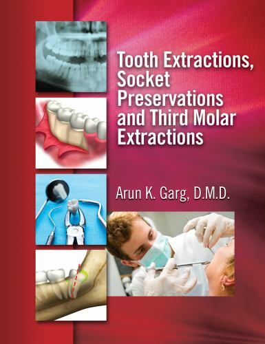 Tooth Extractions, Socket Preservations and Third Molar Extractions ...