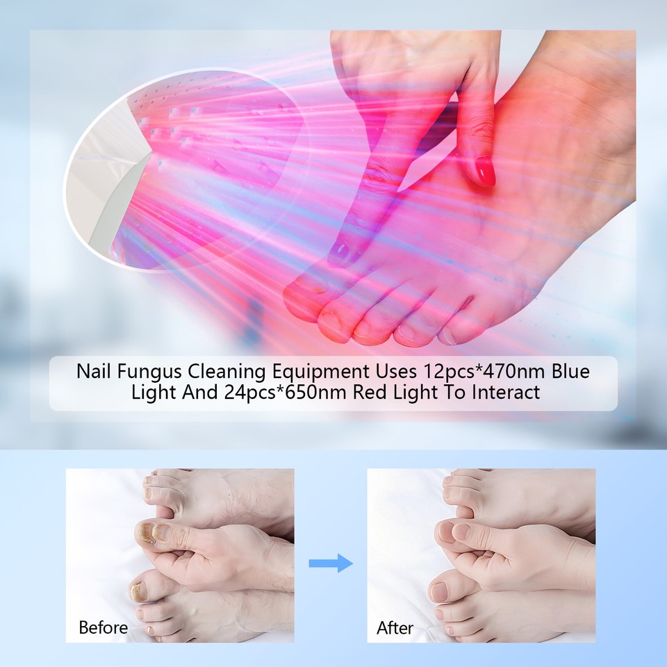 Nail Fungus Laser-Device Onychomycosis Toes Toenail Fungus Treatment ...