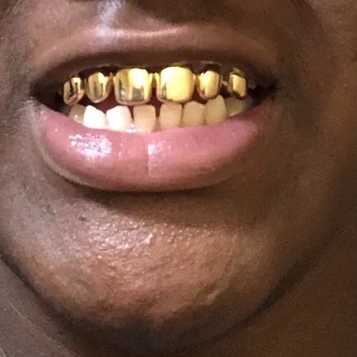 Permanent Gold Teeth