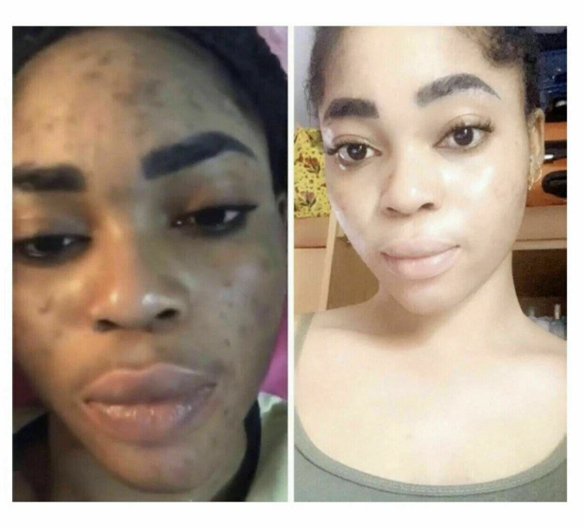 Skin Bleaching Side Effects