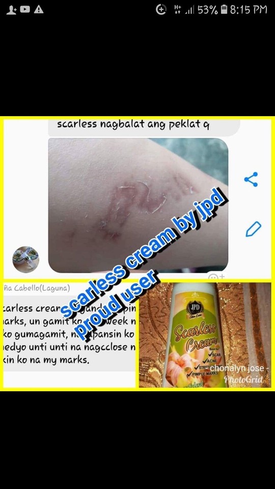 Lot 2 Syringoma Cream Remove Syringoma Scarless Cream Fade and Lighten ...