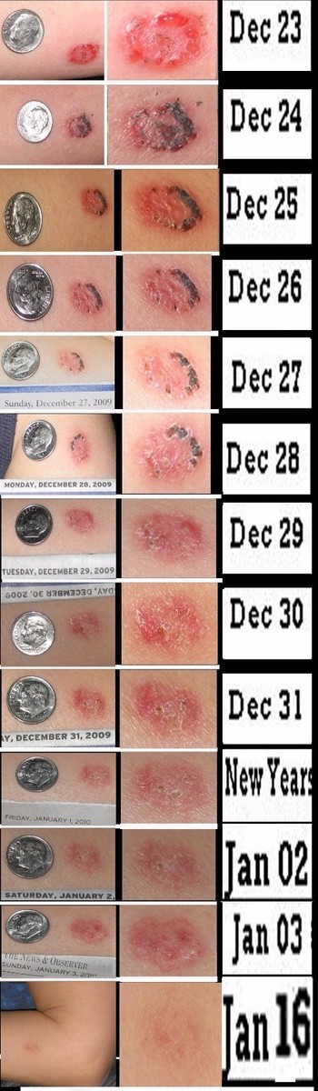 Medium Brown Recluse Spider Bite Stages Brown Recluse Spider Bite