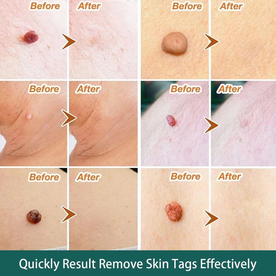 Skin Mole Remover 20ml Professional Painless Face Body Blemish Eraser ...