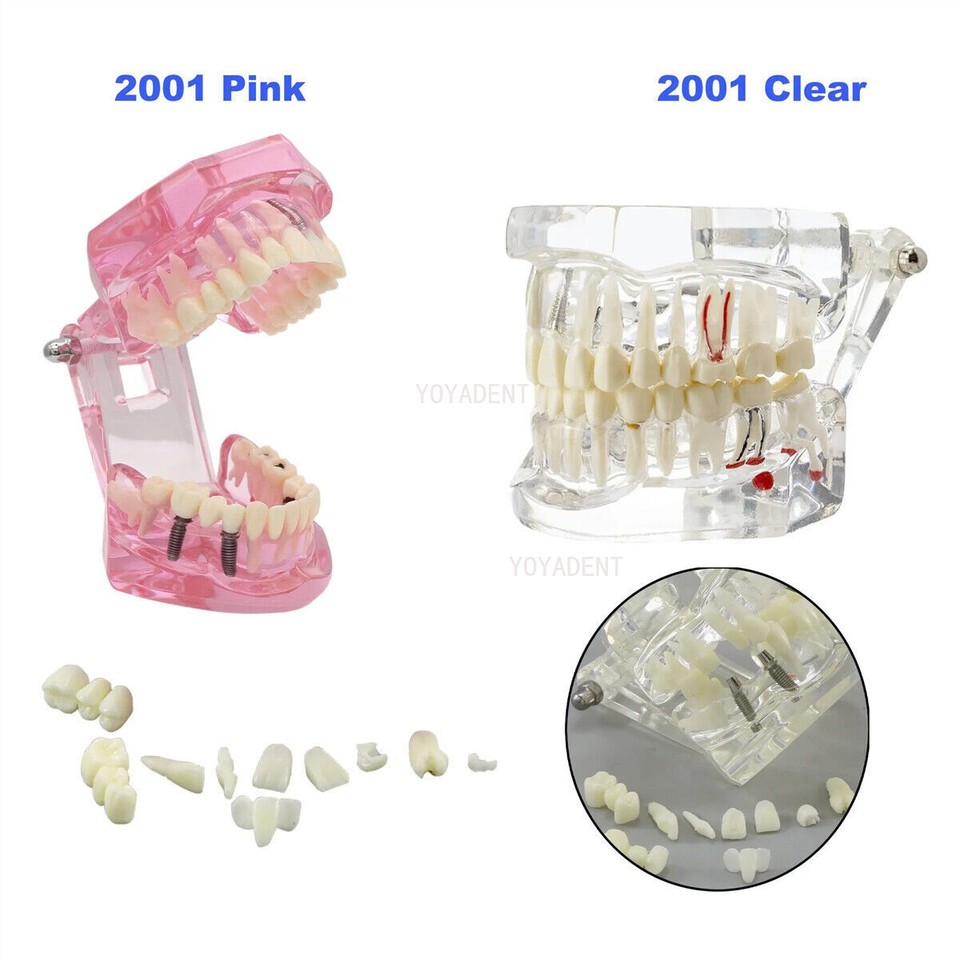 Teeth Model Dental Typodont Ortho Implant Pathological Perio Practice ...