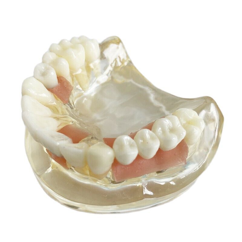 Dental Maryland Bridge Study Model Maxillary Upper Jaw Cuspid Molar ...