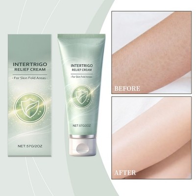 INTERTRIGO RELIEF CREAM – Helps Soothe Irritated Skin, Reduce Moisture ...