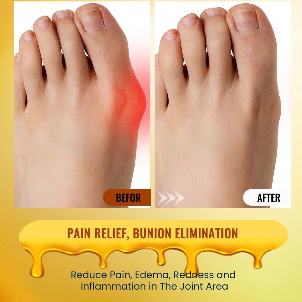 New Bee Venom Foot Gout Treatment Cream Thumb Corrector Finger Hallux ...