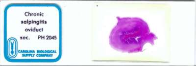 Human Chronic Salpingitis of Oviduct Pathology Microscope Slide | eBay