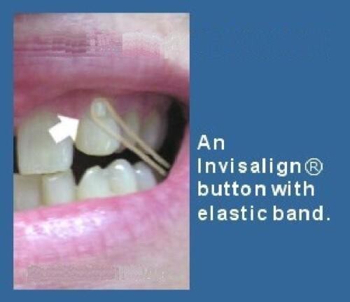 Dental Orthodontic Clear Ceramic Button fit for Invisalign Braces, made ...