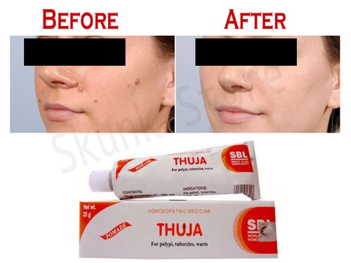 Thuja Homeopathic Medicine for Warts Removal Polypi Tubercles 25g Cream ...