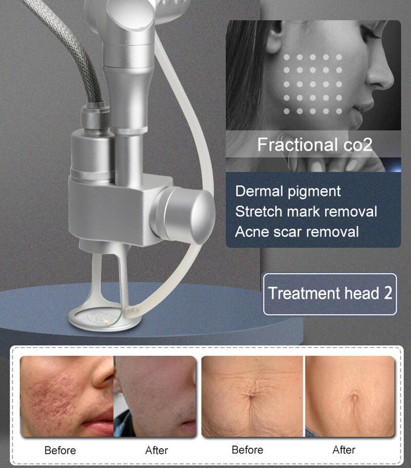 CO2 Fractional Laser Acne Scar Removal Stretch Marks Skin Tightening ...
